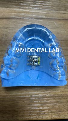 Arch Screw Teeth Palate Expander Perfect Fit Dental Ortho Palatal Expander