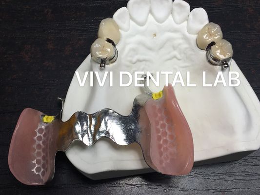 Precise Attachment Partial Denture from China Dental Lab