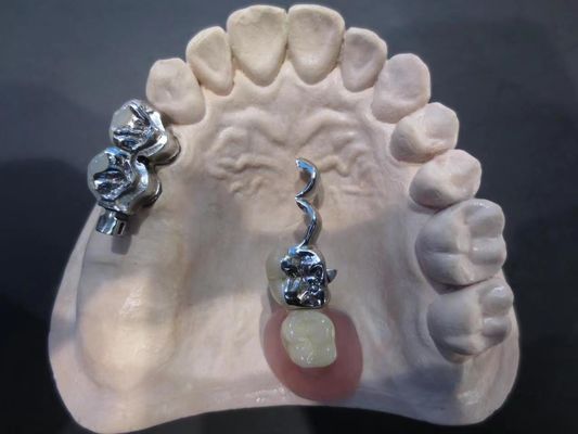Precise Attachment Partial Denture from China Dental Lab
