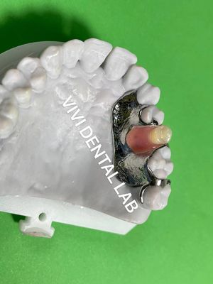 Unilateral Metal Partial Denture China Dental Lab