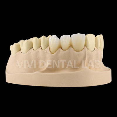 High Strength Natural Anatomical China Dental Lab Crowns
