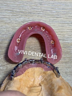 Dental Bar Implant Assisted Dentures High Esthetics Good Fit with ...