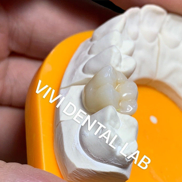 Solid Dental Lab Crowns 3D Pro High Translucency Full Zirconia Crowns ...