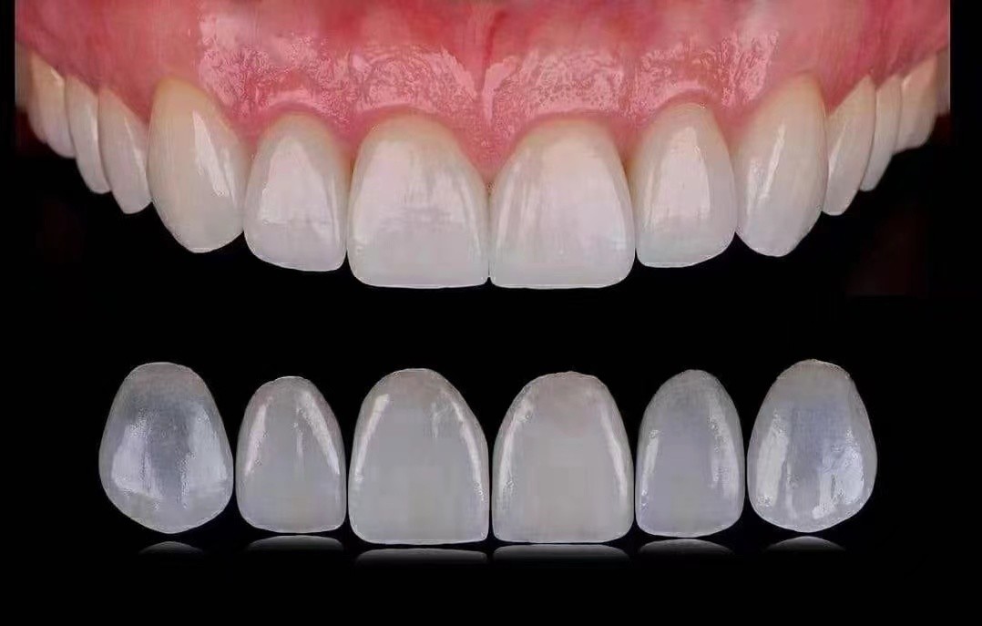 Tranlucent Emax Laminate Veneers / Porcelain Dental Veneers ISO Approved