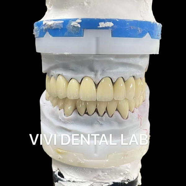 Digital CAD CAM Dental Lab Crowns Translucent Layered Zirconia Crown