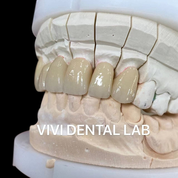 Single Layered Telescopic Dental Lab Crowns Zirconia Noritake Porcelain