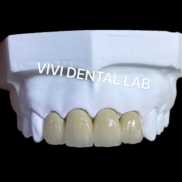 Metal Ceramic Crown PFM Crown and Bridge from China Dental Lab