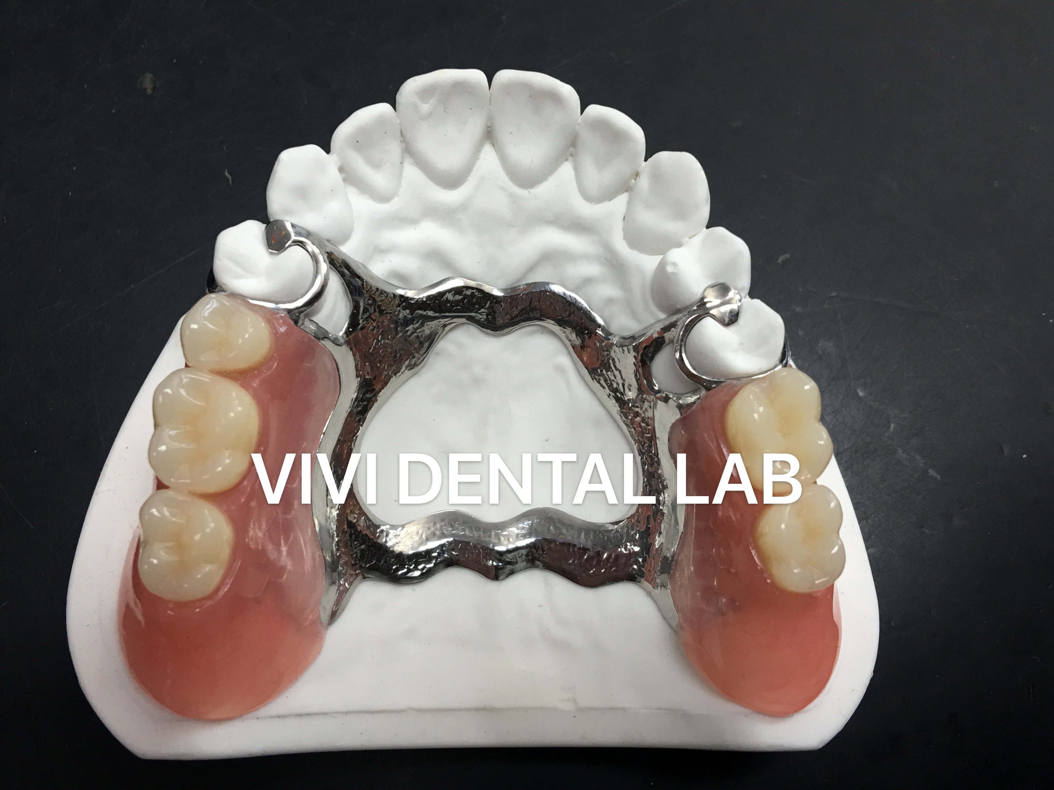 Alloy Metal Partial Denture Framework 3 Shape Exocad Laser Printing