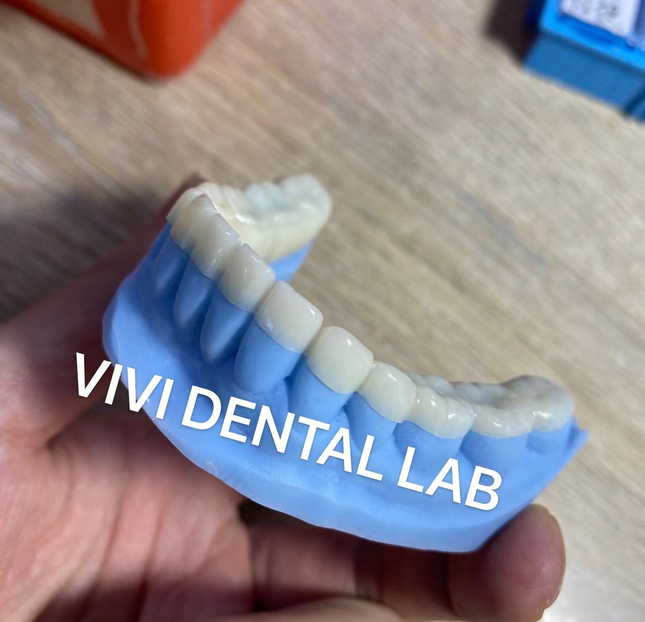 Designed Milled Dental Snap On Teeth For Increasing Vertical Bite