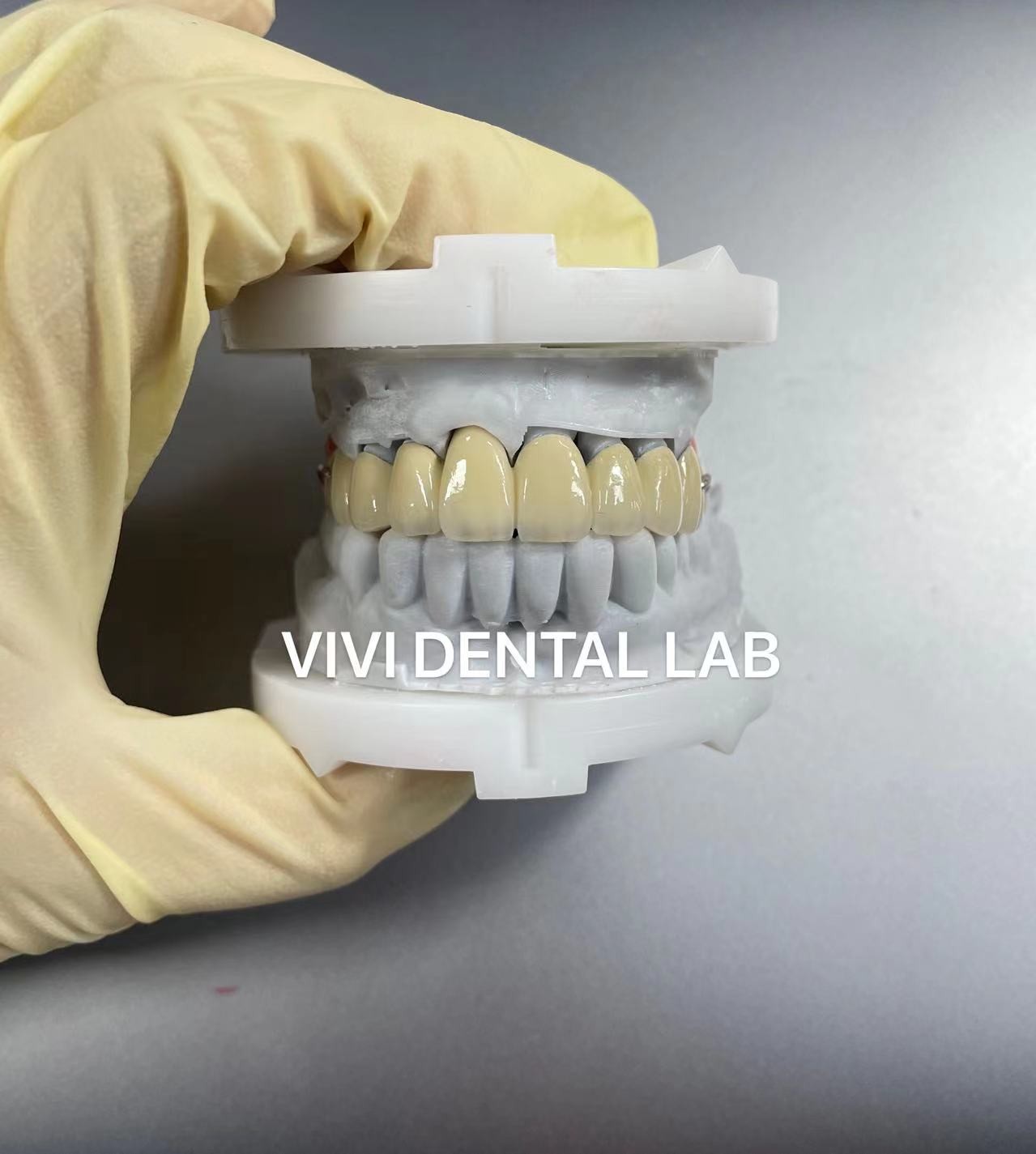 Scheftner Ivoclar Metal Partial Denture Combination PFM Dental Bridge