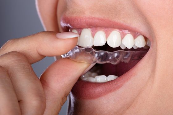 clear correct aligners – Quality Supplier from China
