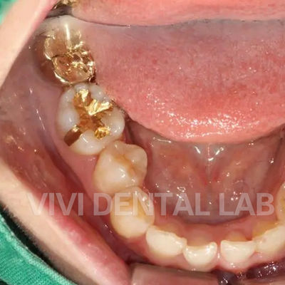 Dental Crown and Bridge on sales of page 5 - Quality Dental Crown and ...