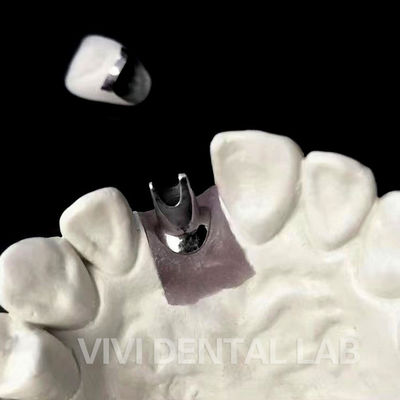 Implant Crown and Bridge on sales of page 3 - Quality Implant Crown and ...
