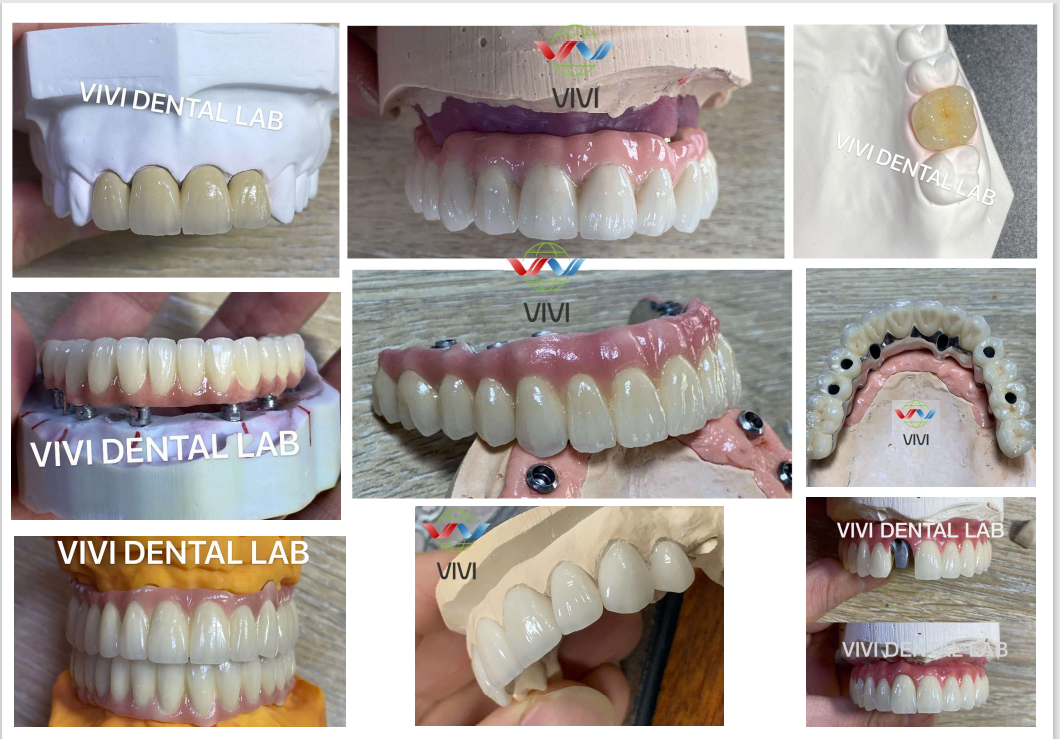 Arch Screw Teeth Palate Expander Perfect Fit Dental Ortho Palatal Expander