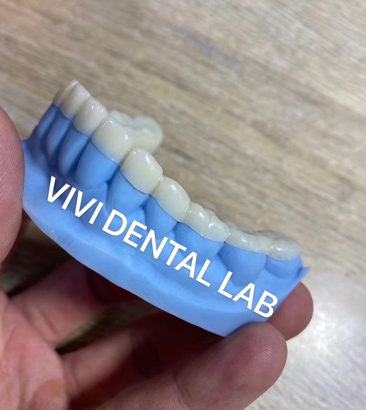 Designed Milled Dental Snap On Teeth For Increasing Vertical Bite