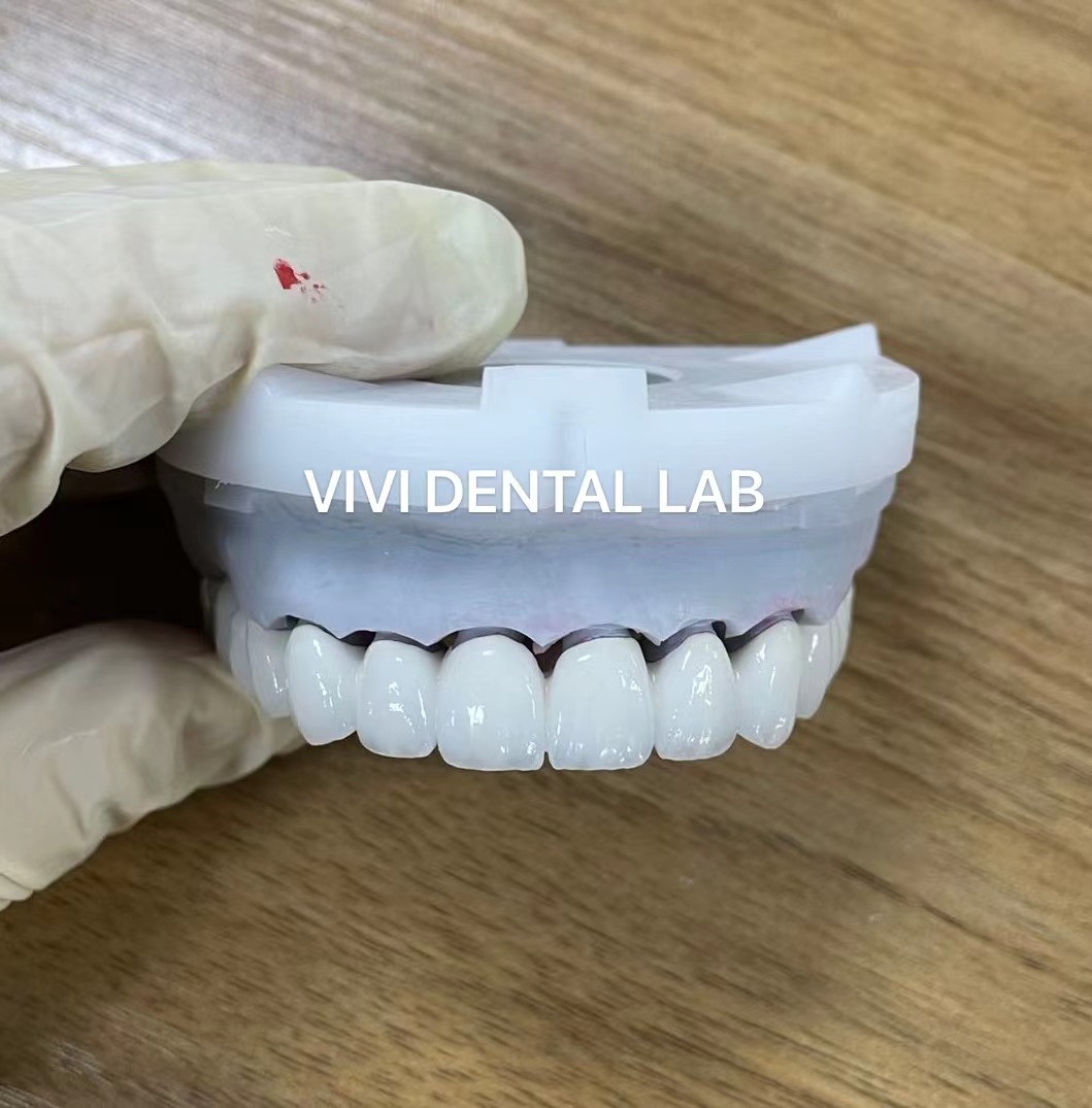 Super White Zirconia Dental Lab Crowns 3D PRO PFZ Noritake Porcelain