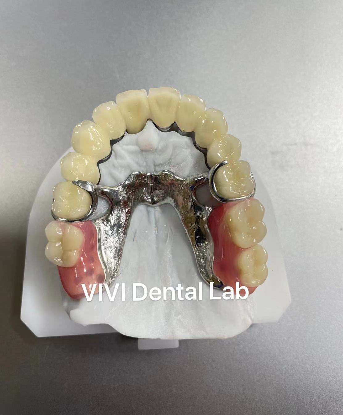 Scheftner Ivoclar Metal Partial Denture Combination PFM Dental Bridge